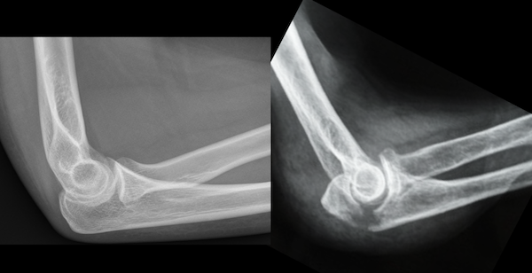 Olecranon fracture